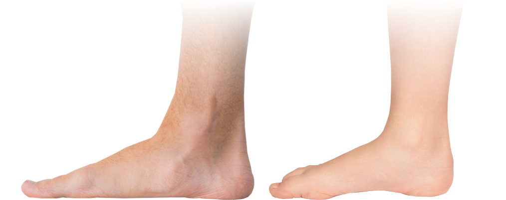 Pie plano | Piédica