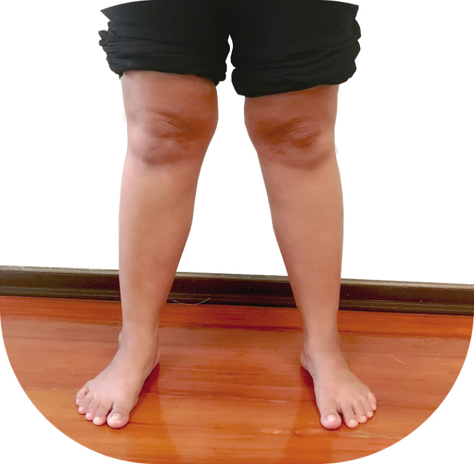 Piédica - Padecimientos - Pisada pronador y pie valgo